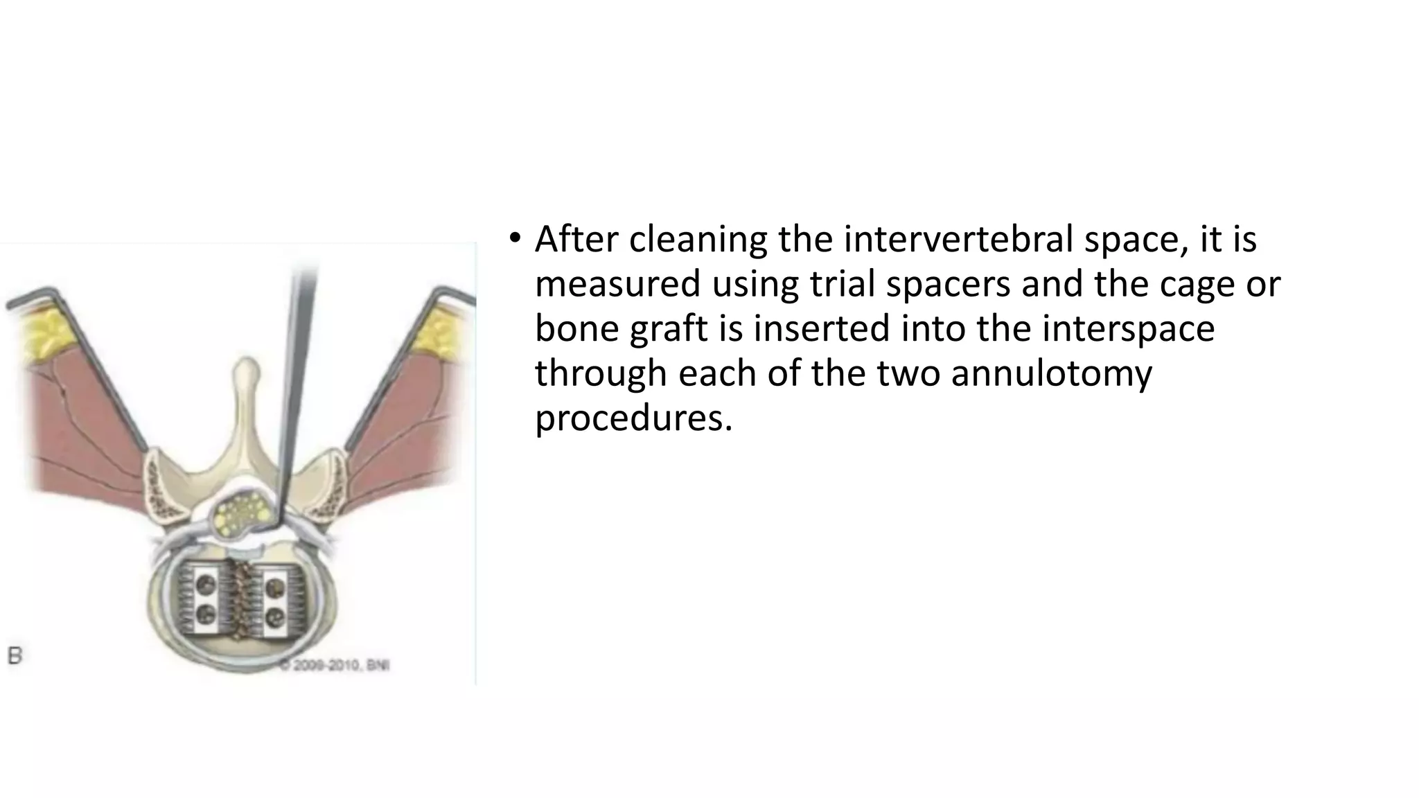 Lumbar interbody fusion.pptx