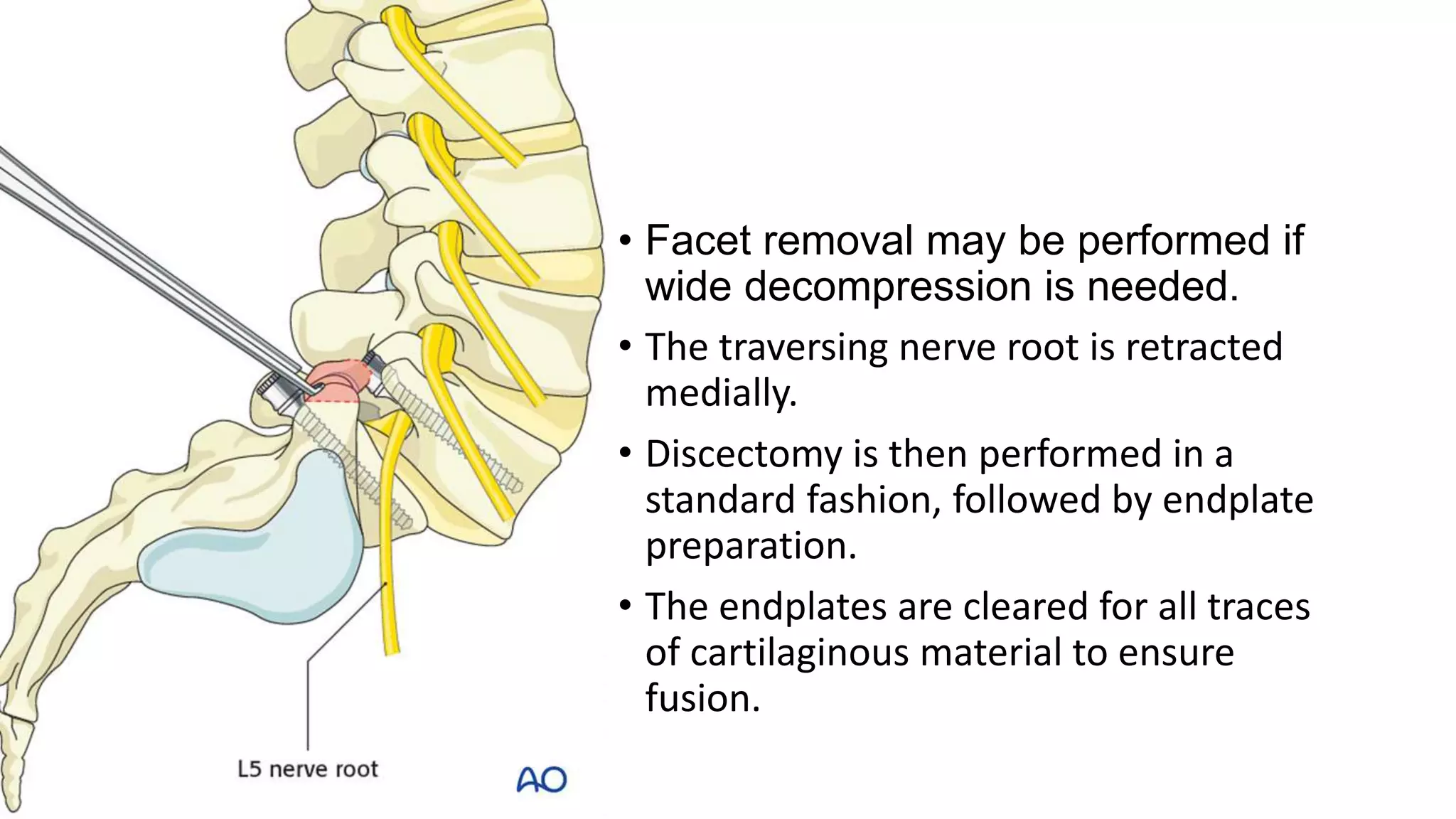 Lumbar interbody fusion.pptx
