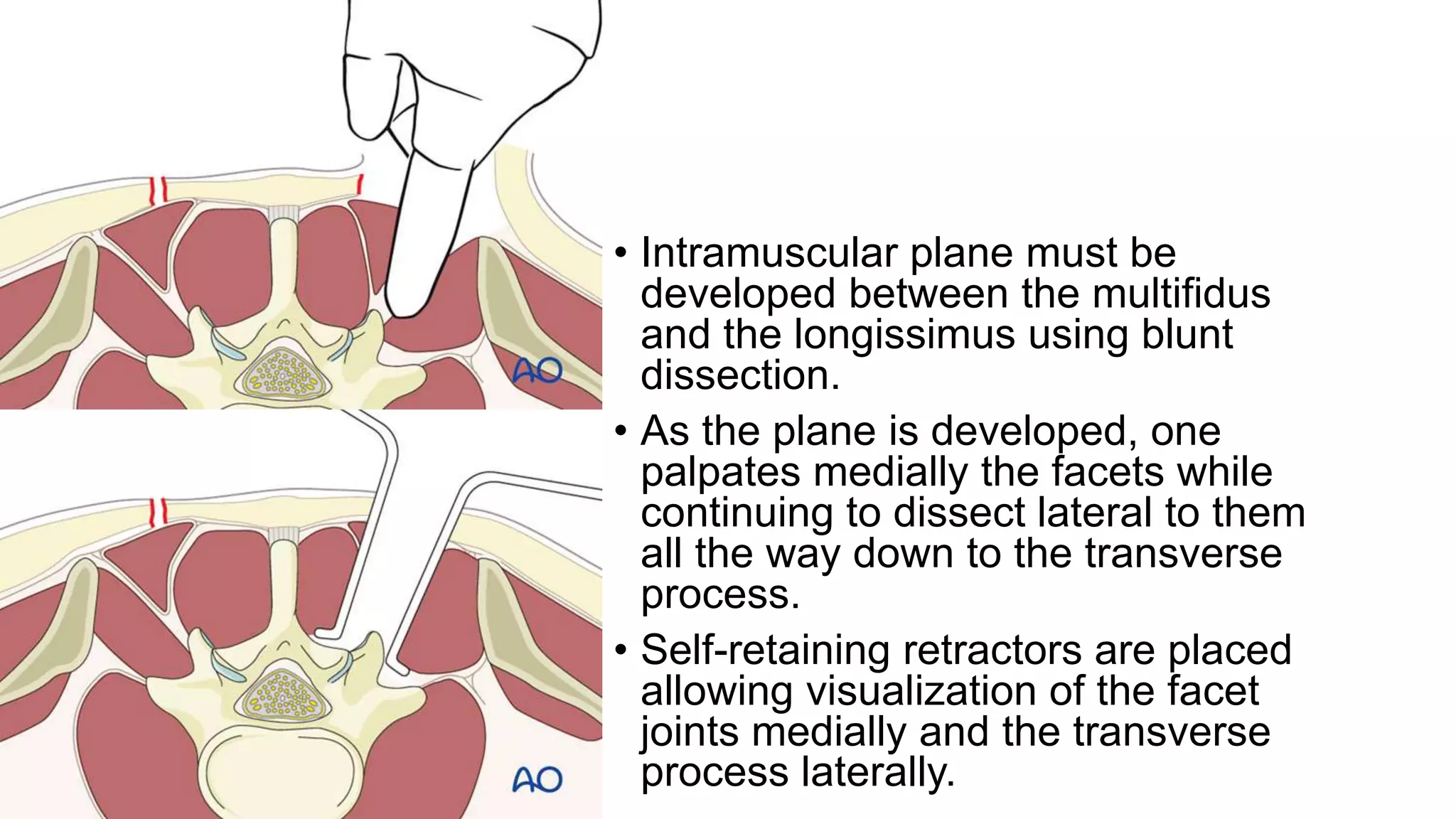Lumbar interbody fusion.pptx