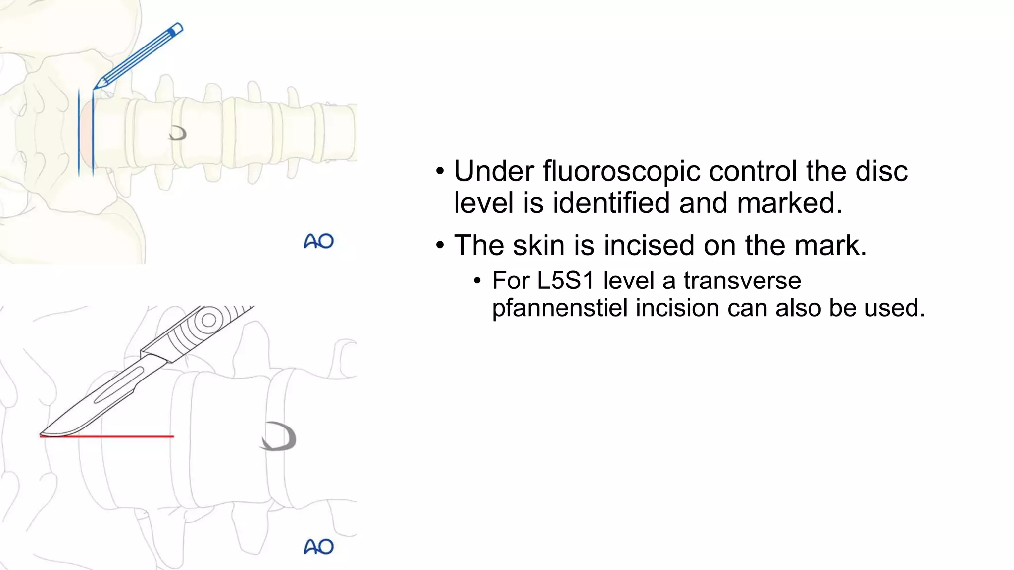 Lumbar interbody fusion.pptx