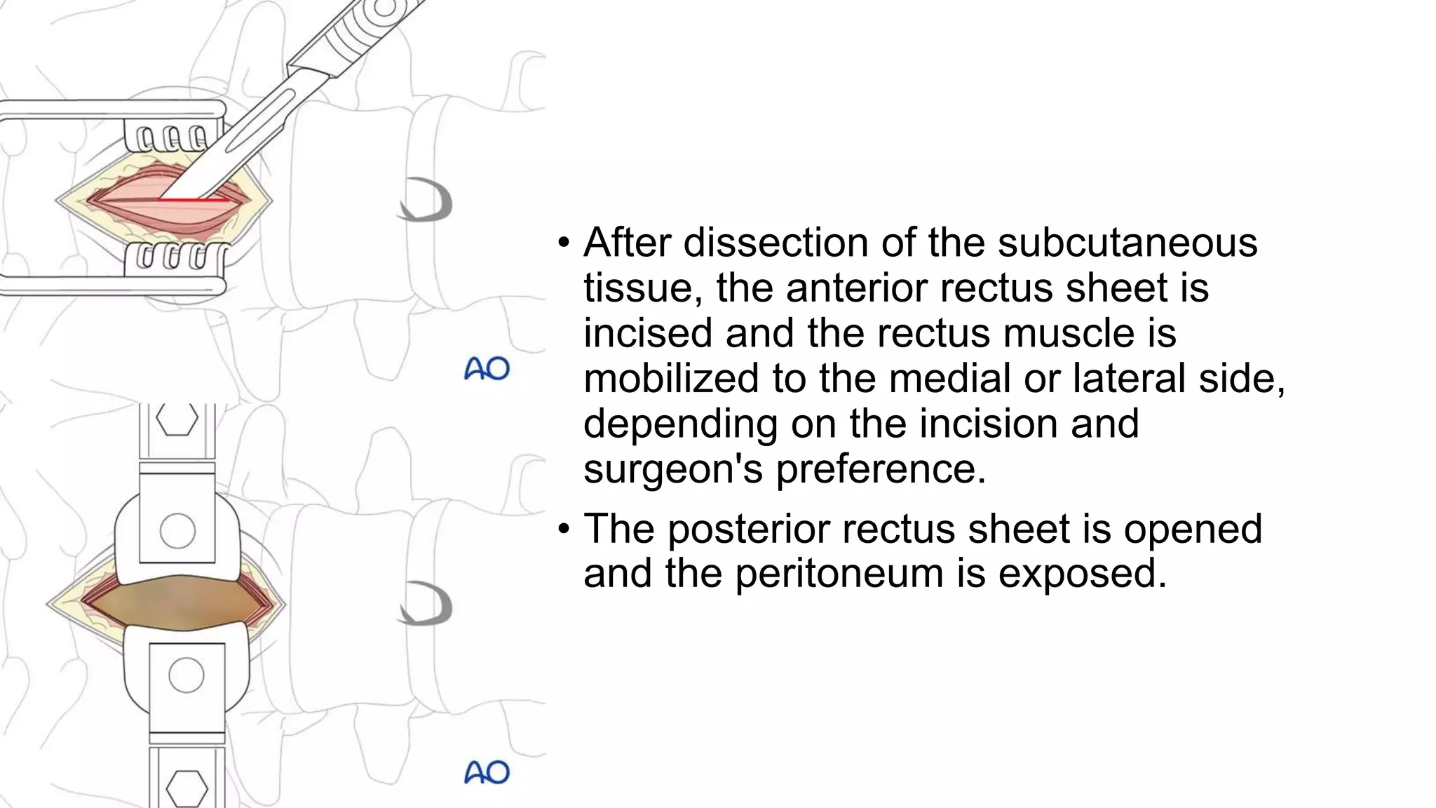 Lumbar interbody fusion.pptx