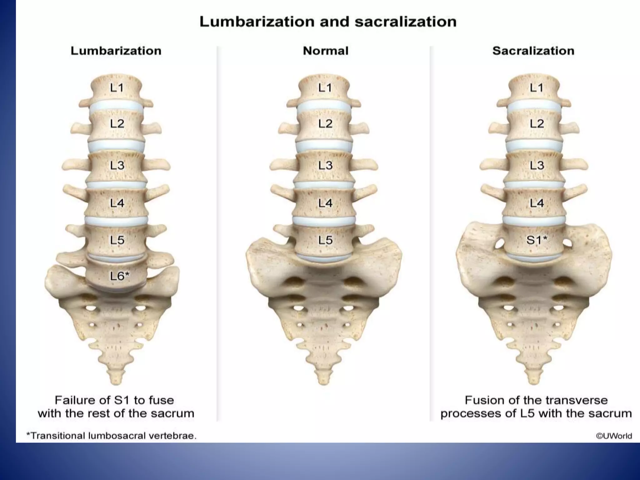 lumbarisation.pptx