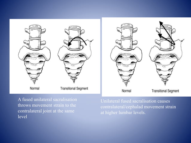 lumbarisation.pptx | Physical Therapy | Wellness