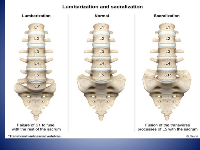 lumbarisation.pptx | Physical Therapy | Wellness