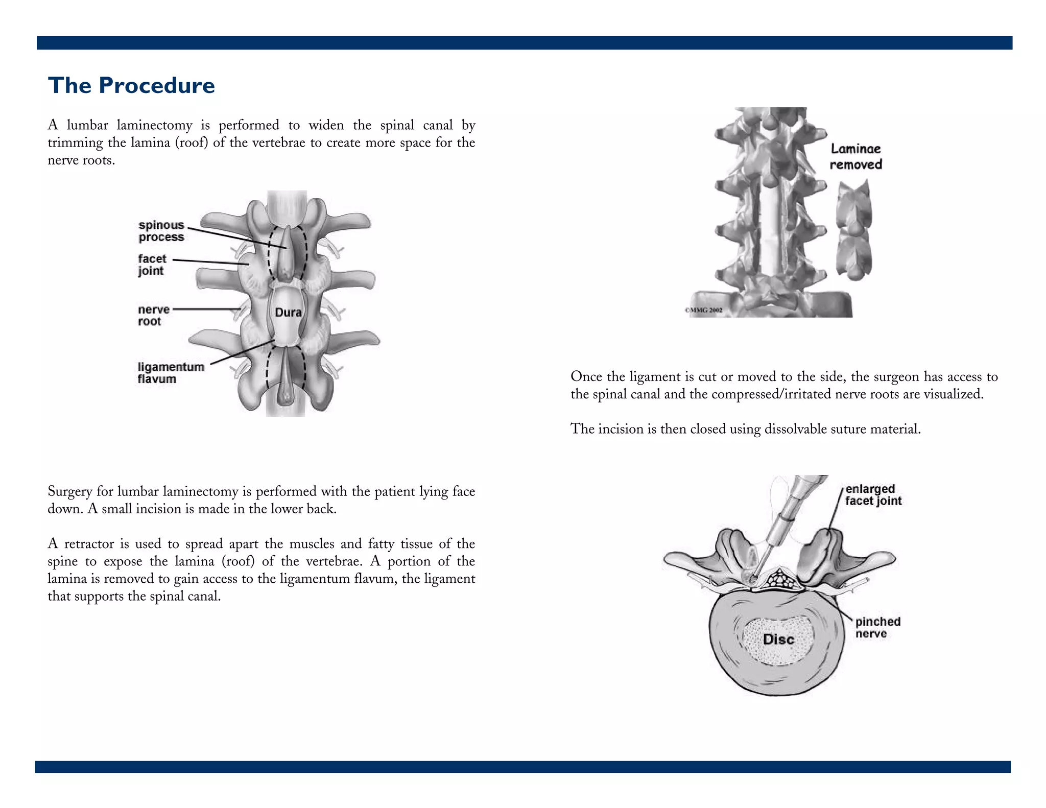 Lumbar Laminectomy | PDF