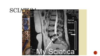 Lumbar plexus plexopathy.pptx