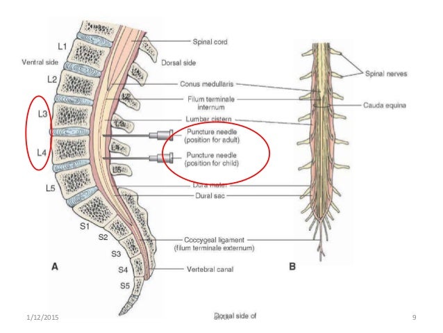 Lumbar puncture