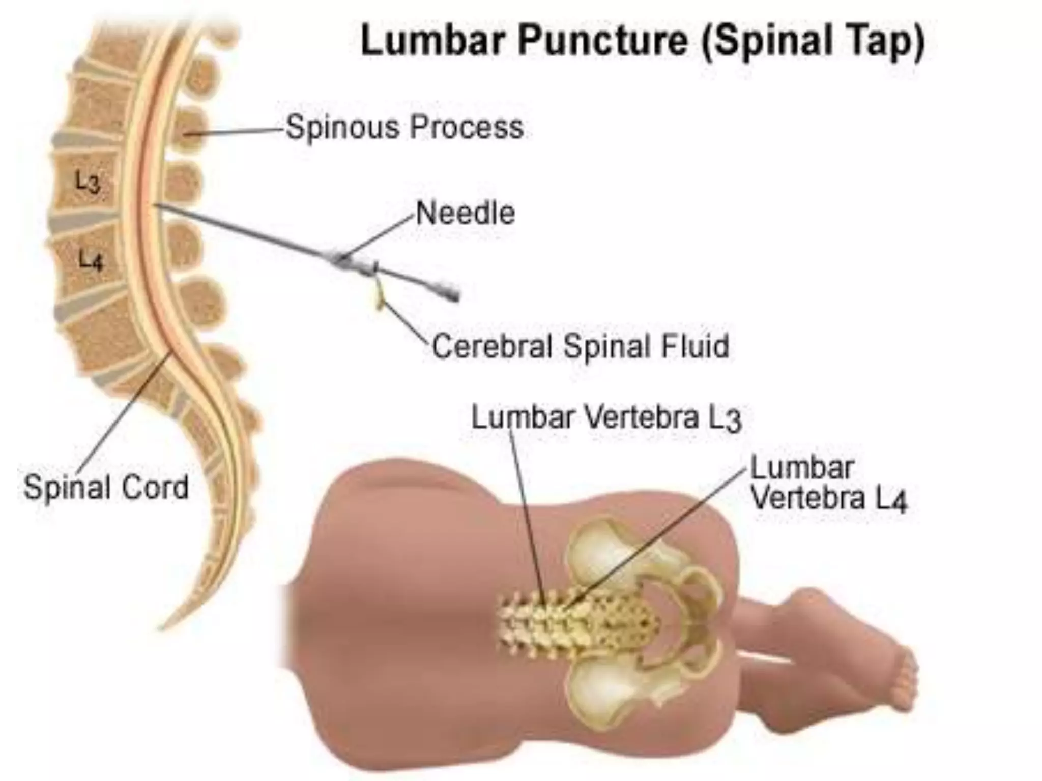 Lumbar puncture | PPT