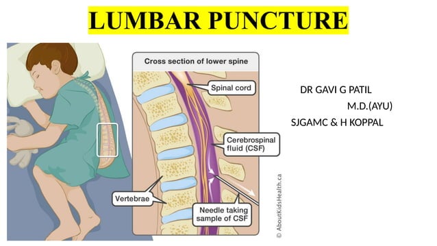 LUMBAR PUNCTURE.in children by dr gavi g patil | PPTX