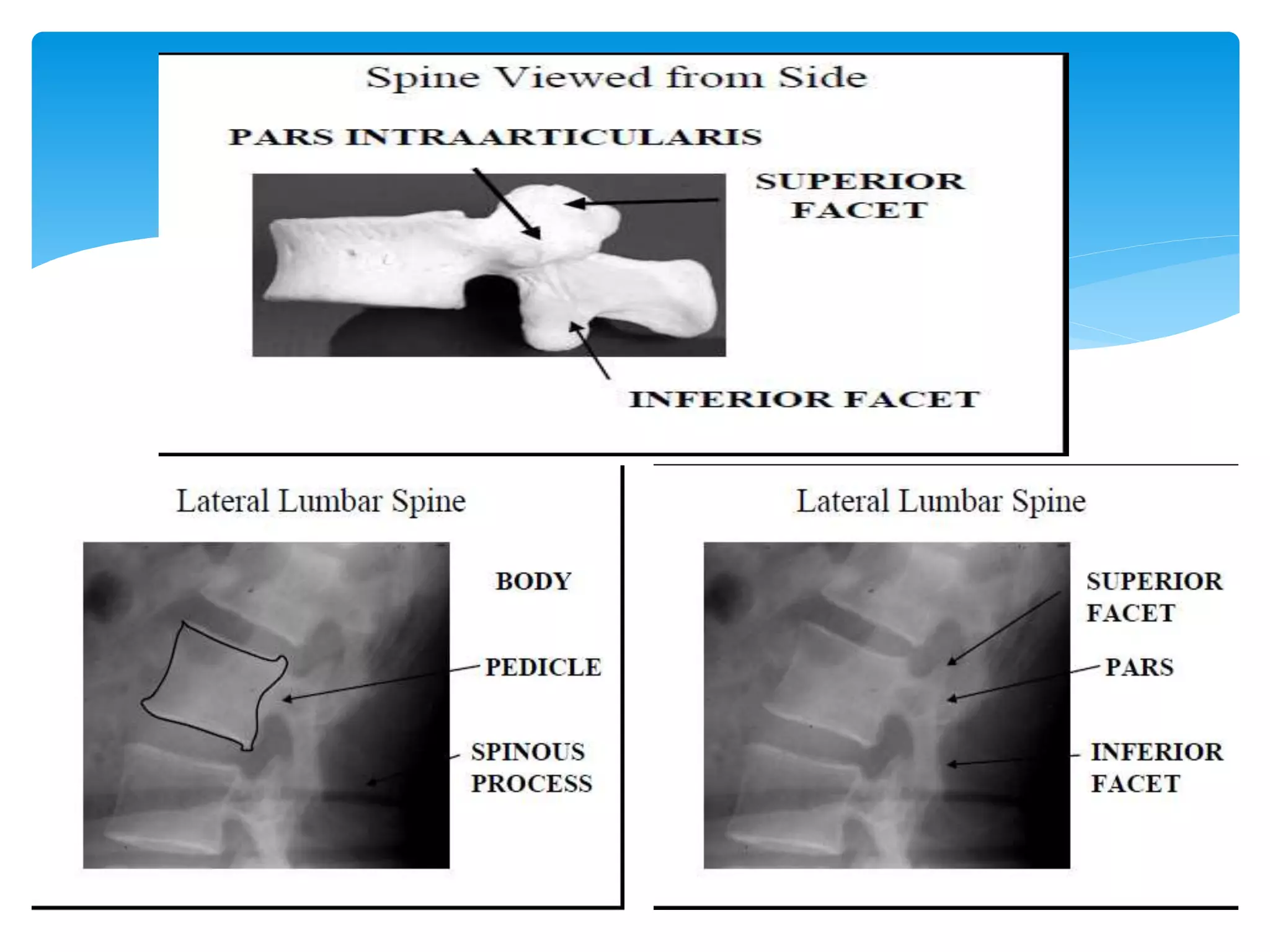 Practical Radiology Of Lumbar spine | PPTX