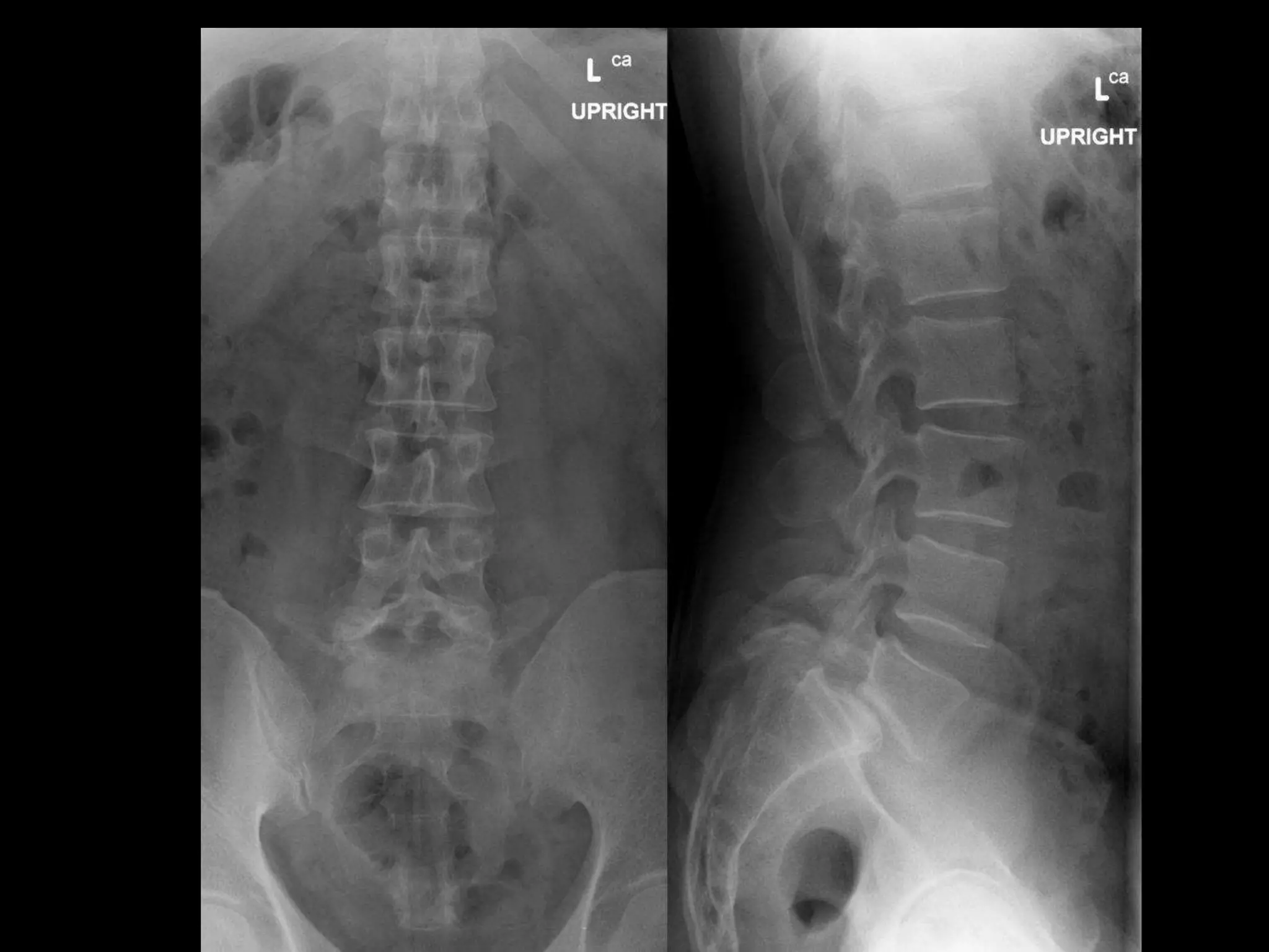 Practical Radiology Of Lumbar spine | PPTX