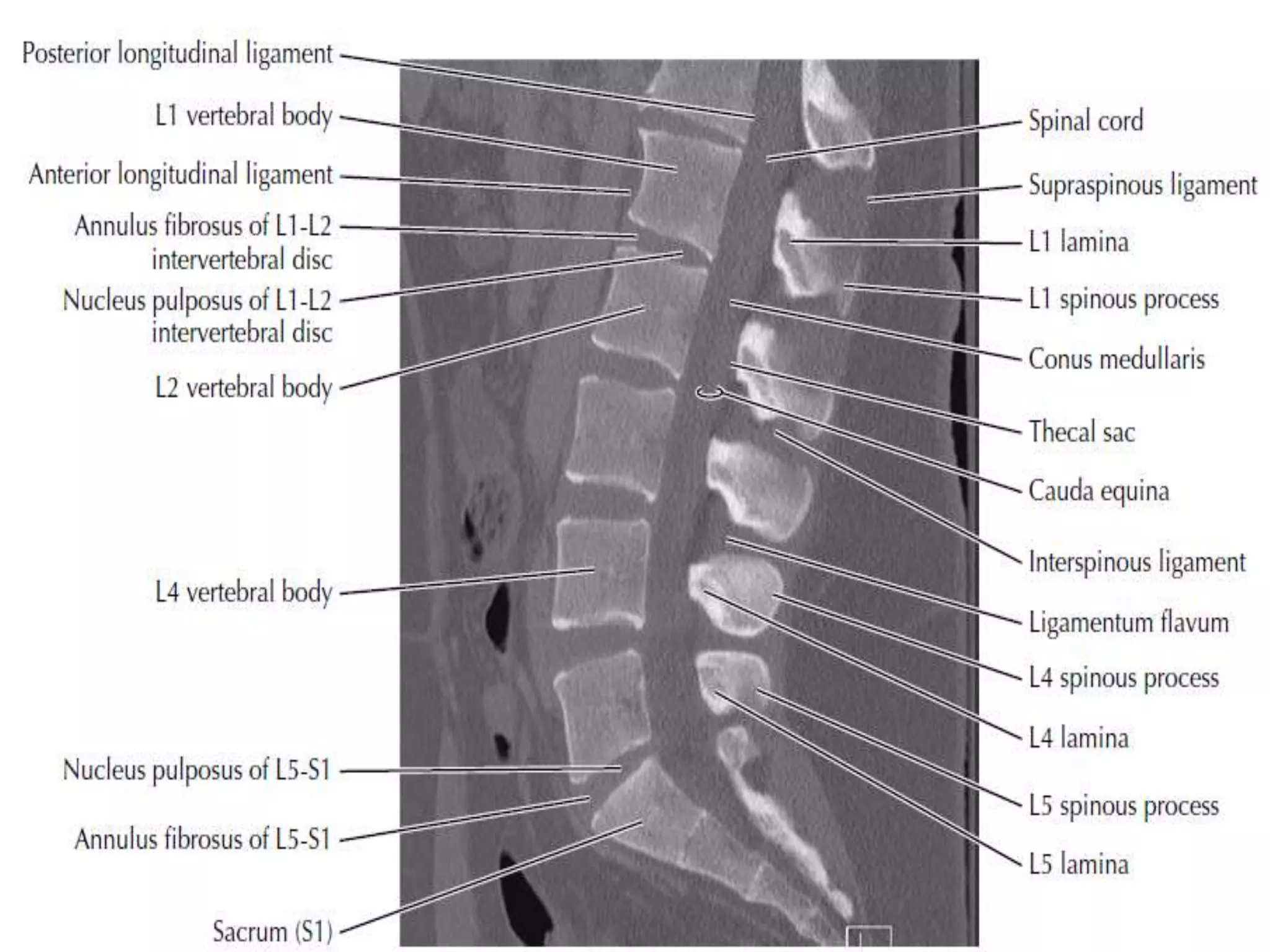 Practical Radiology Of Lumbar spine | PPTX