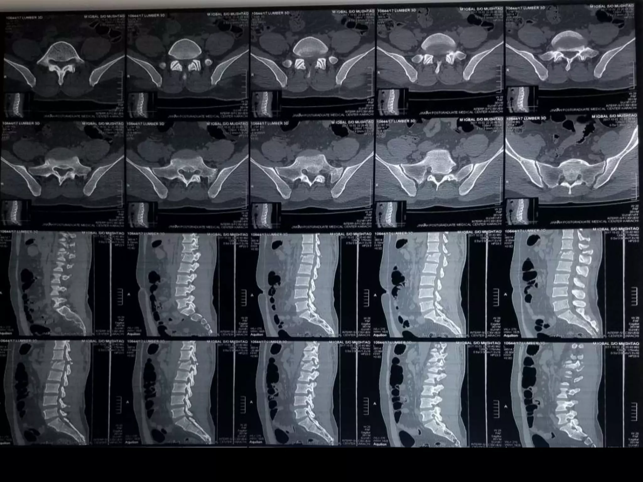 Practical Radiology Of Lumbar spine | PPTX