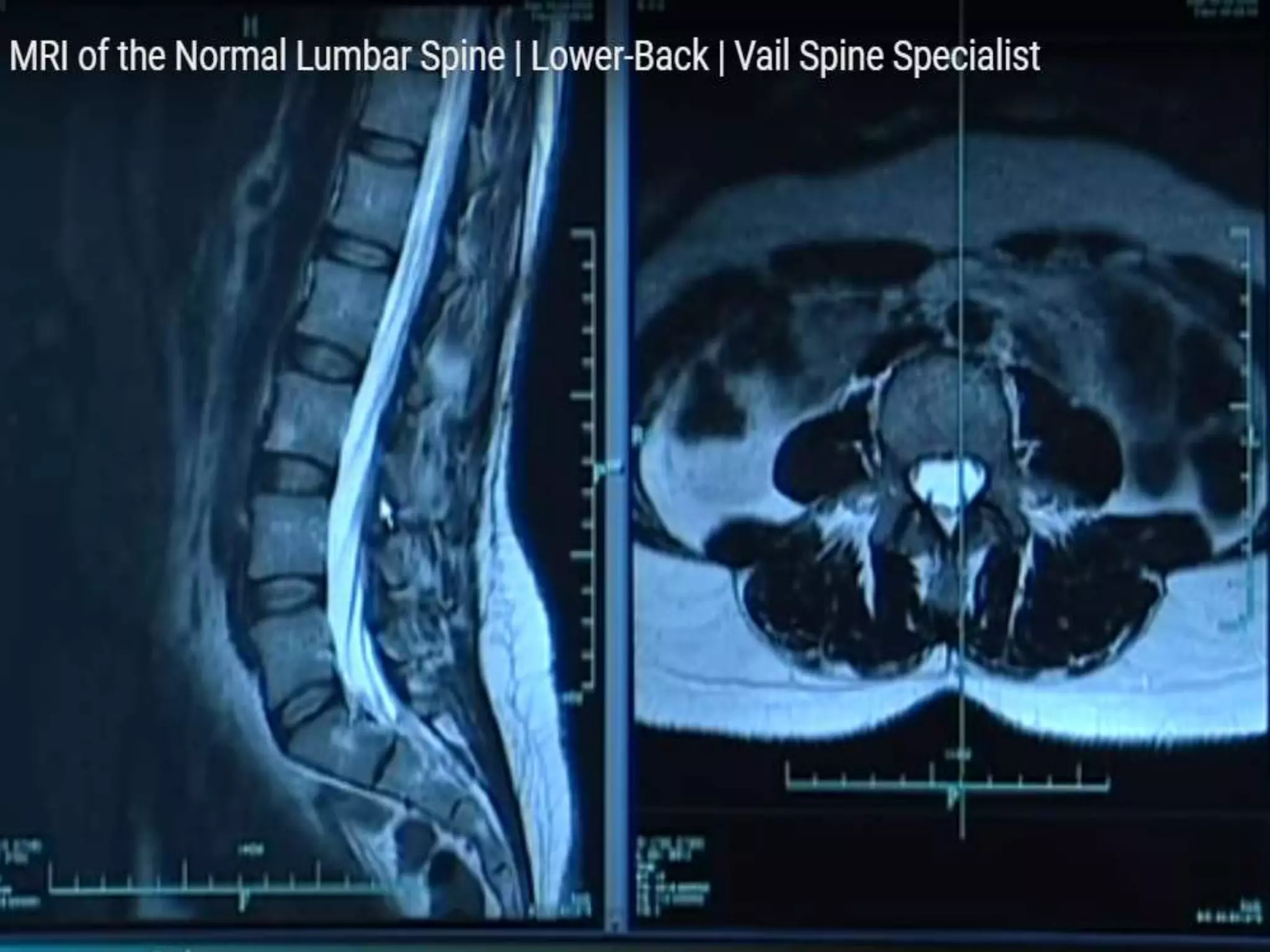 Practical Radiology Of Lumbar spine | PPTX