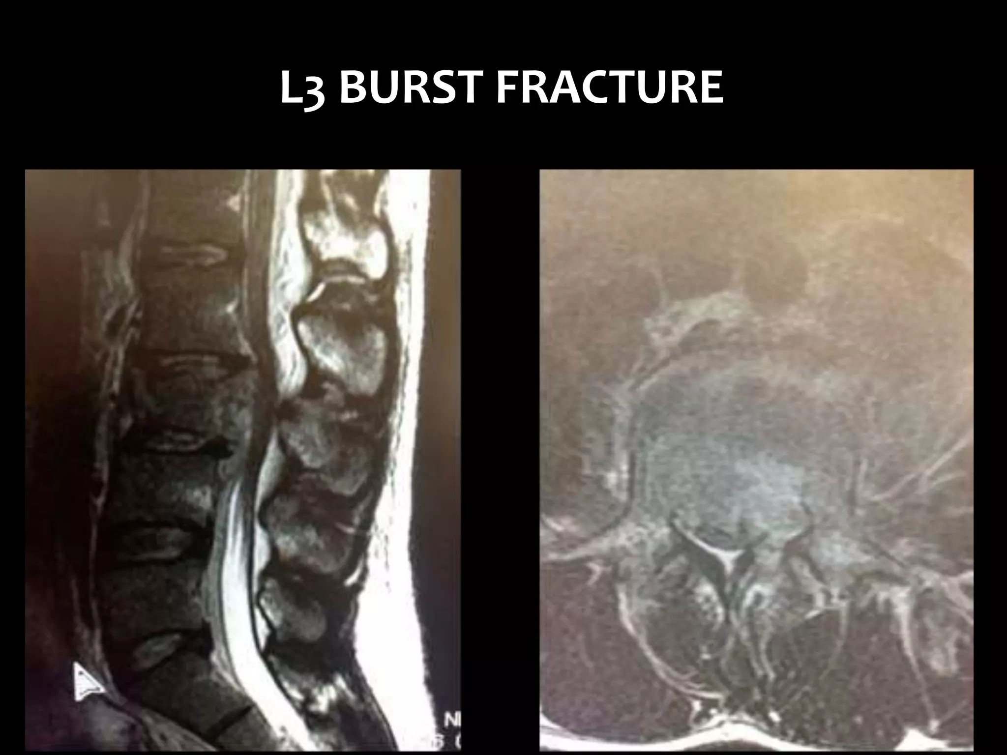 Practical Radiology Of Lumbar spine | PPTX