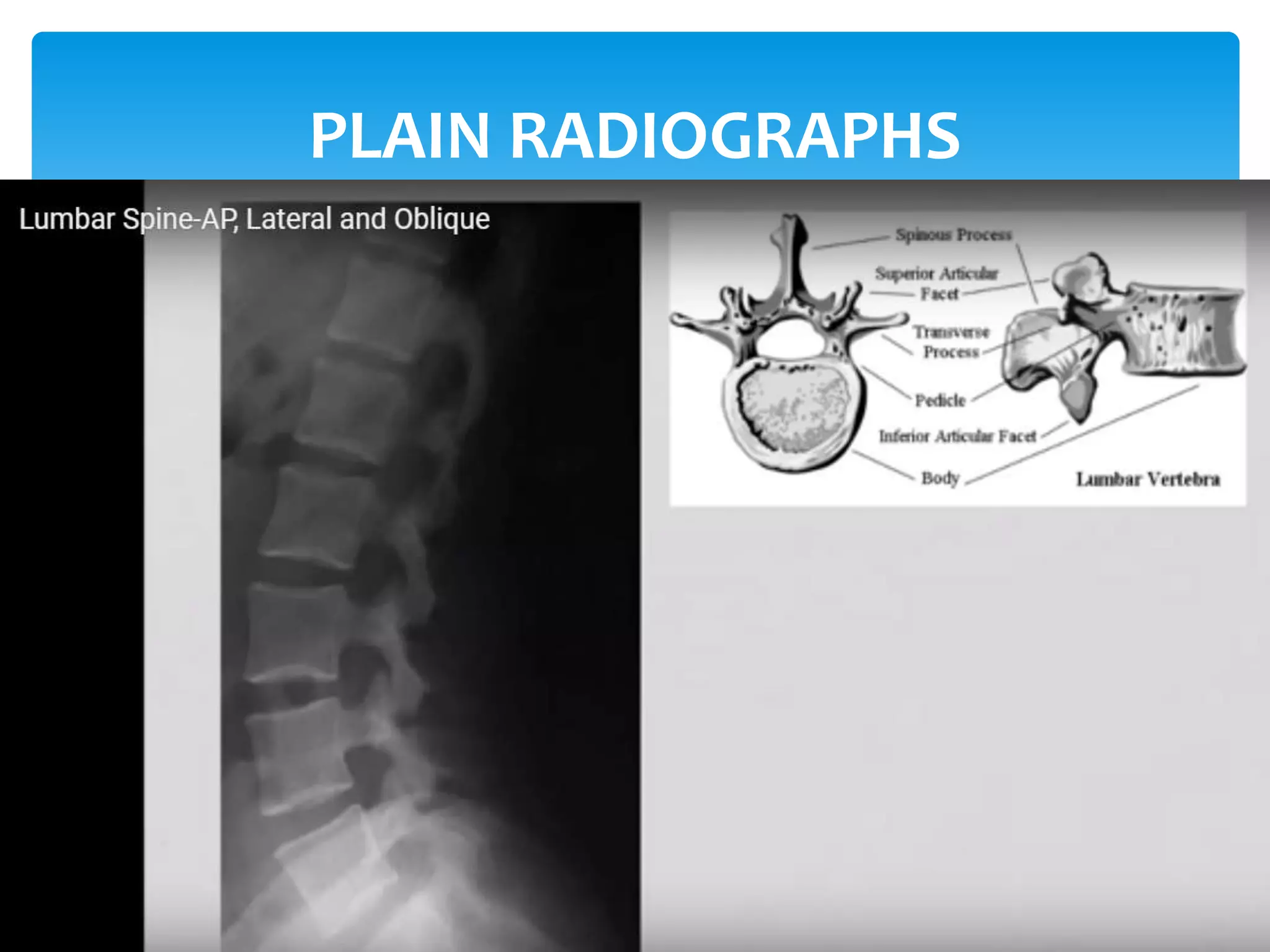 Practical Radiology Of Lumbar spine | PPTX