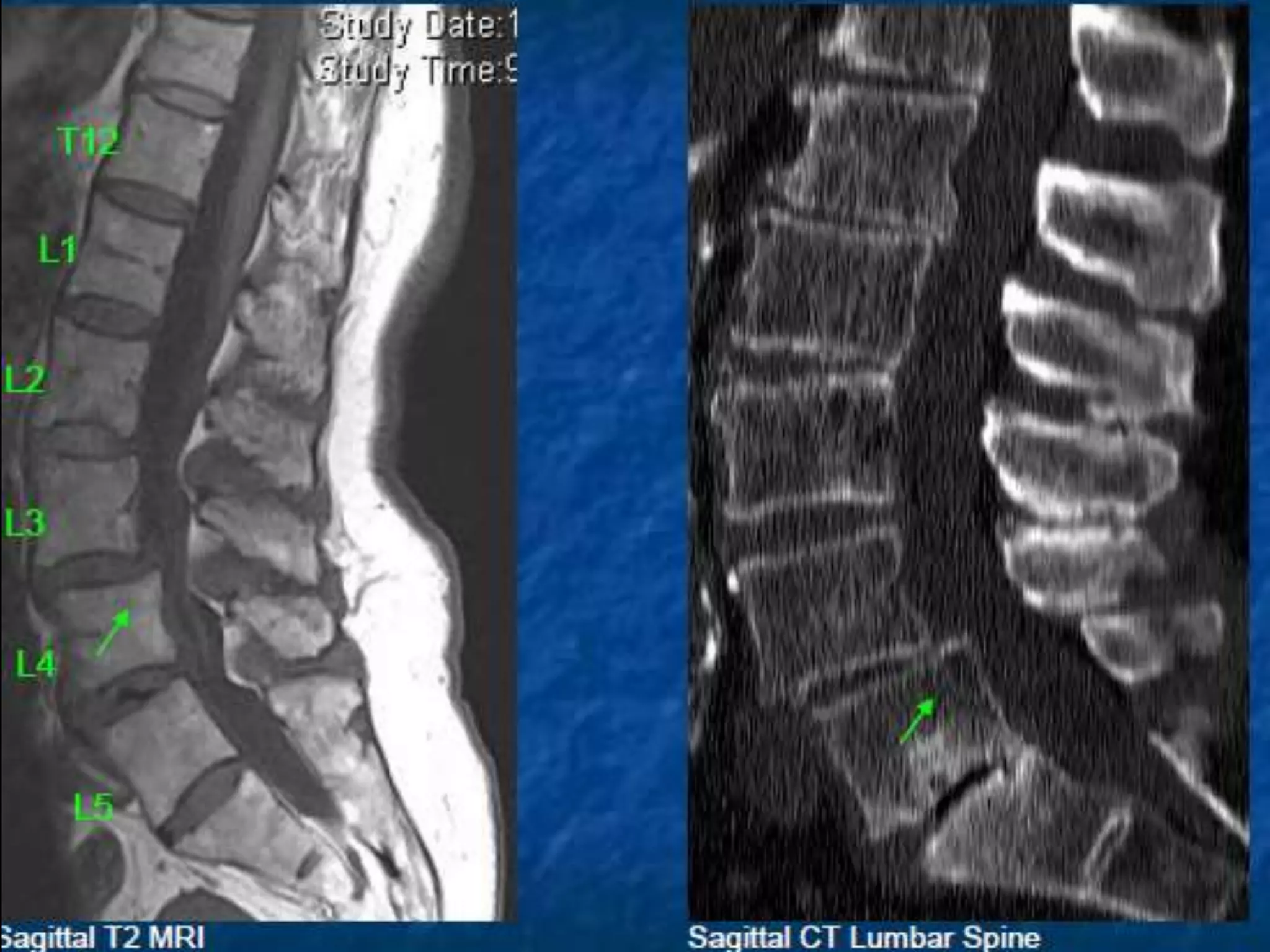 Practical Radiology Of Lumbar spine | PPTX