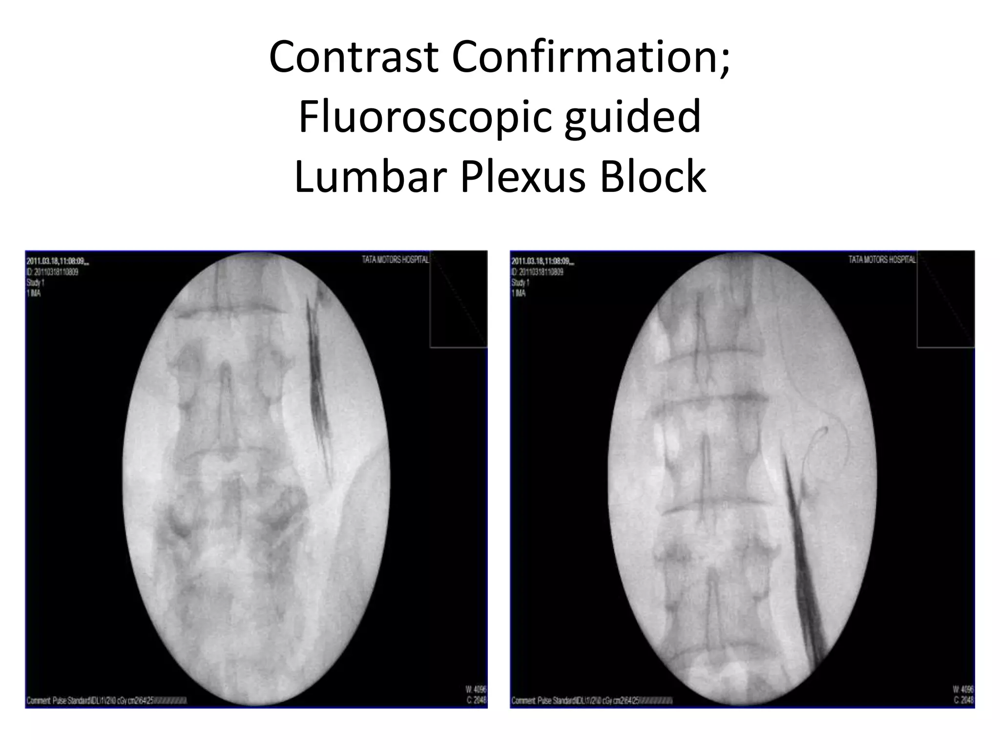 Lumbar+ Sacral Plexus Block.ppt