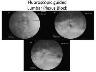 Lumbar+ Sacral Plexus Block.ppt