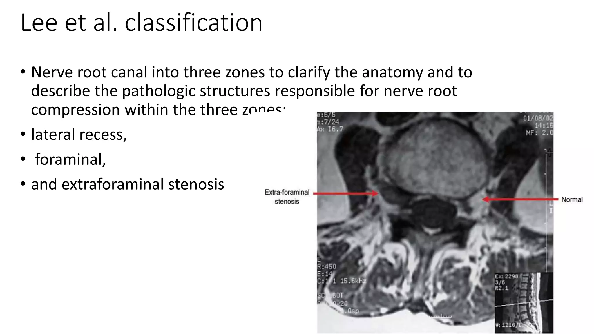 Lumbar spinal stenosis | PPTX
