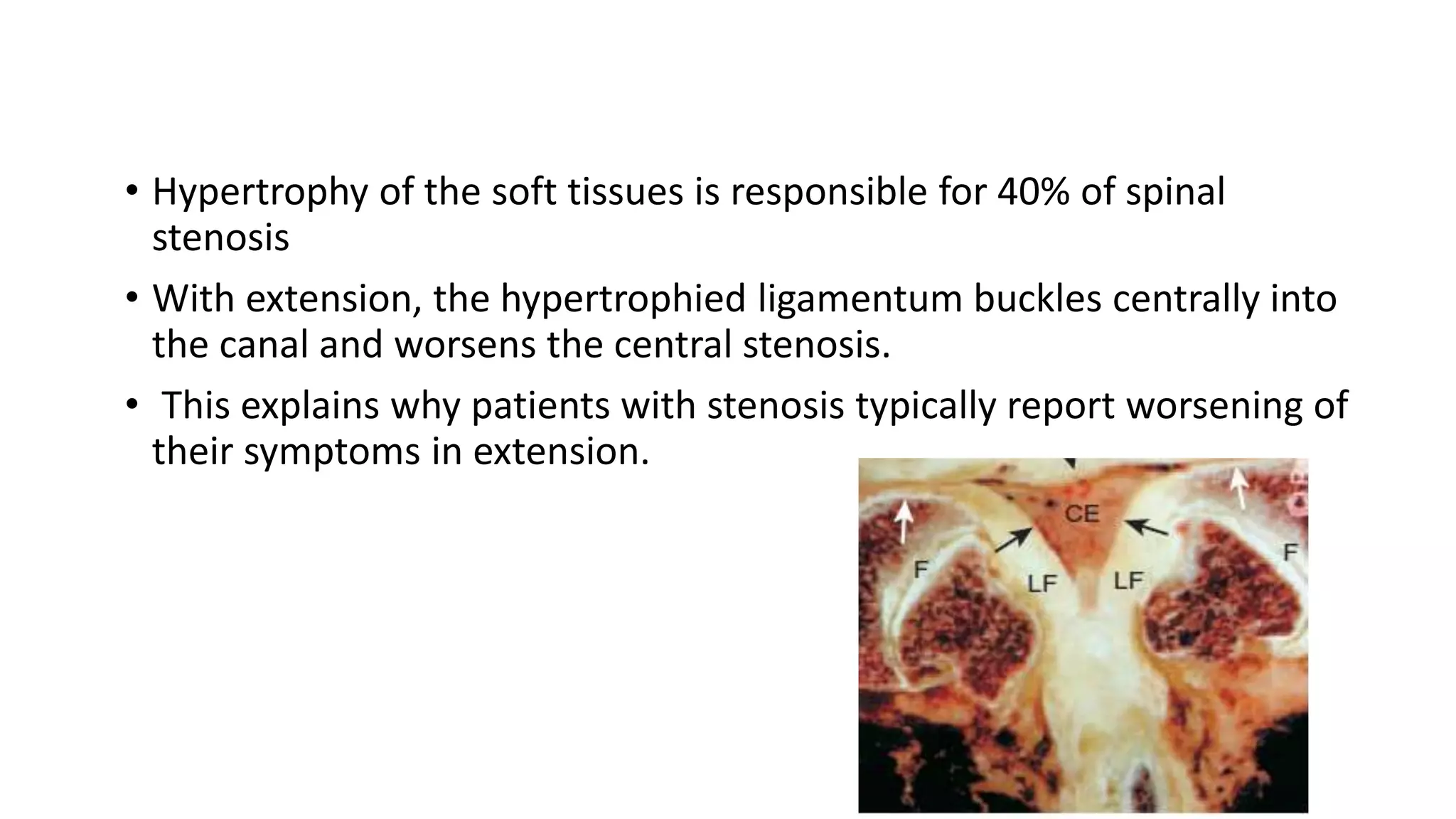Lumbar spinal stenosis | PPTX