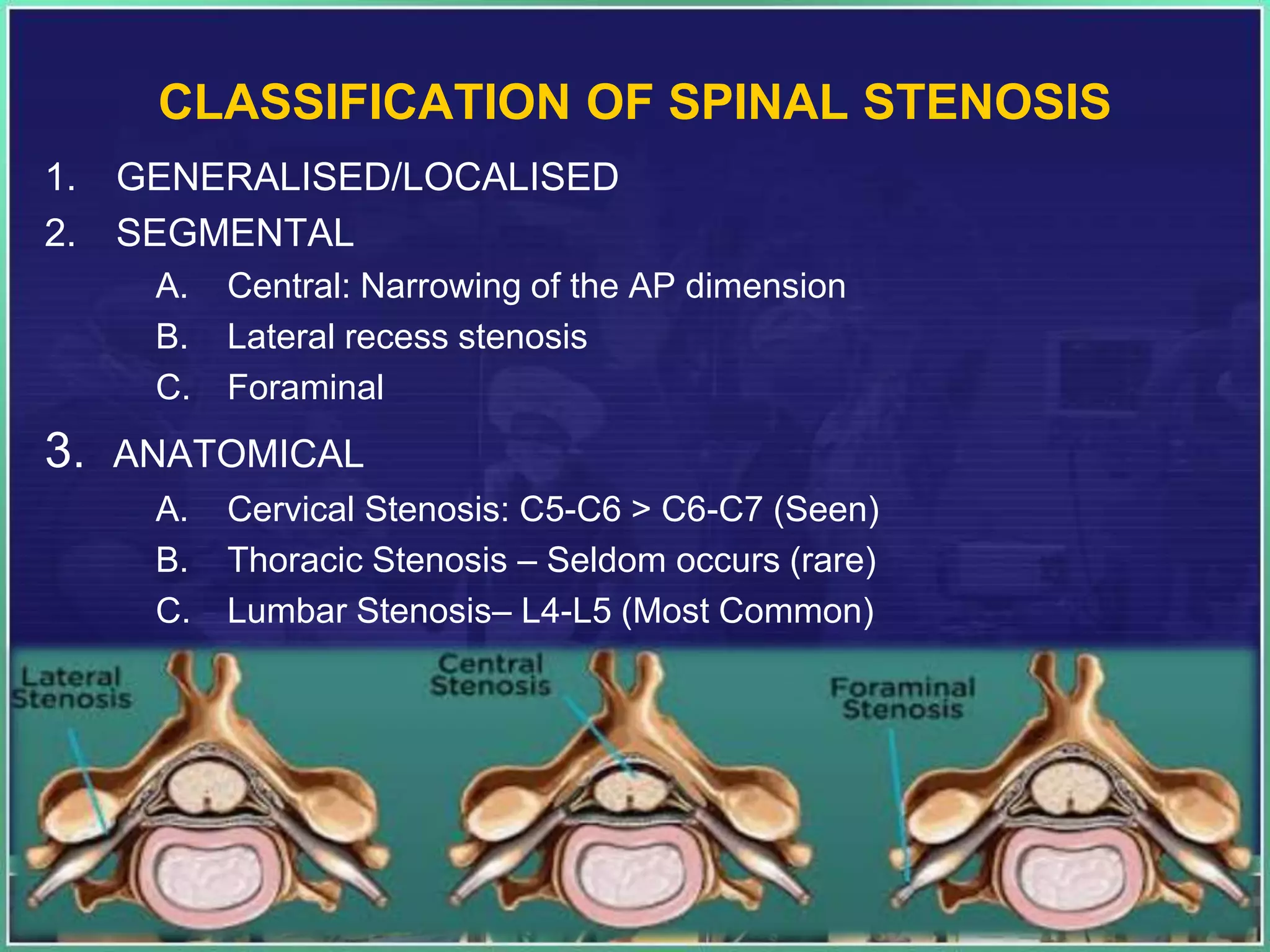 Lumbar spinal stenosis, laminectomy, prolapsed intervertebral disc | PPTX