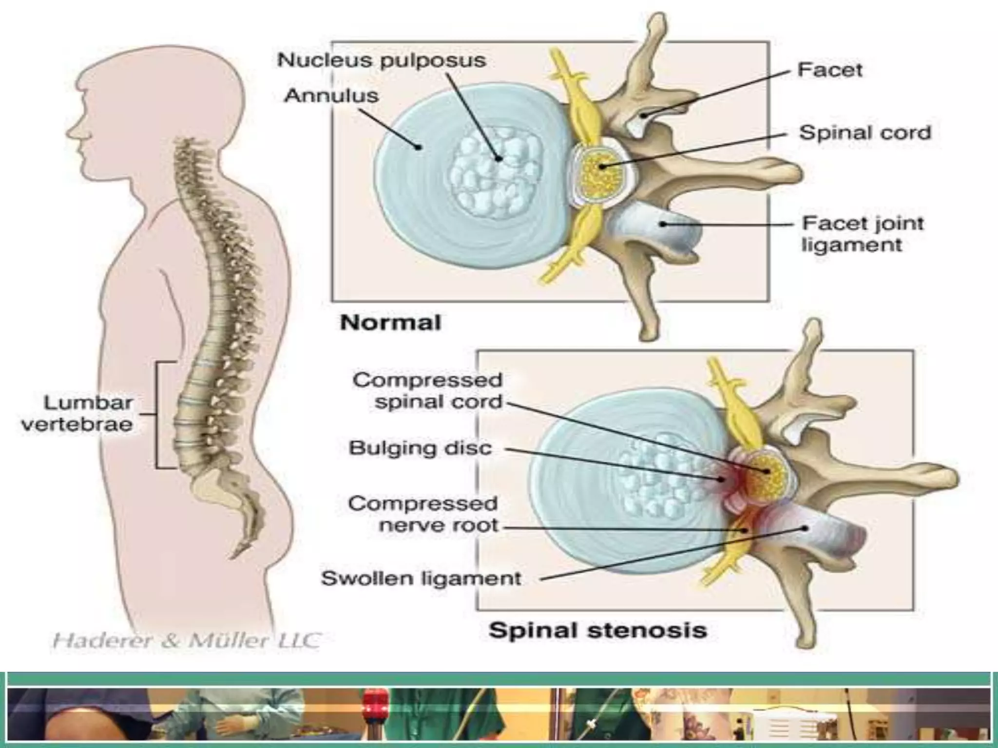 Lumbar spinal stenosis, laminectomy, prolapsed intervertebral disc | PPTX