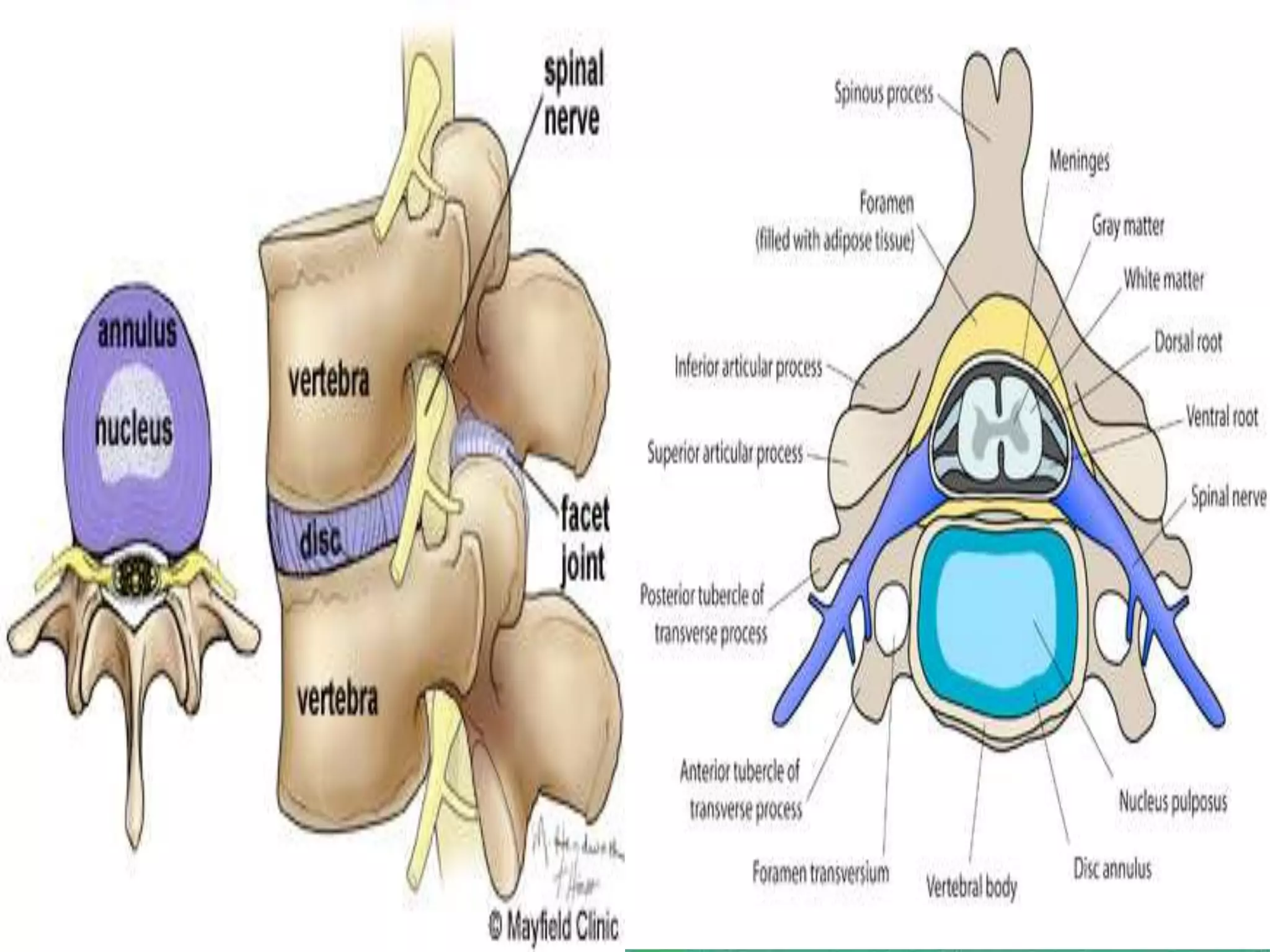 Lumbar spinal stenosis, laminectomy, prolapsed intervertebral disc | PPTX
