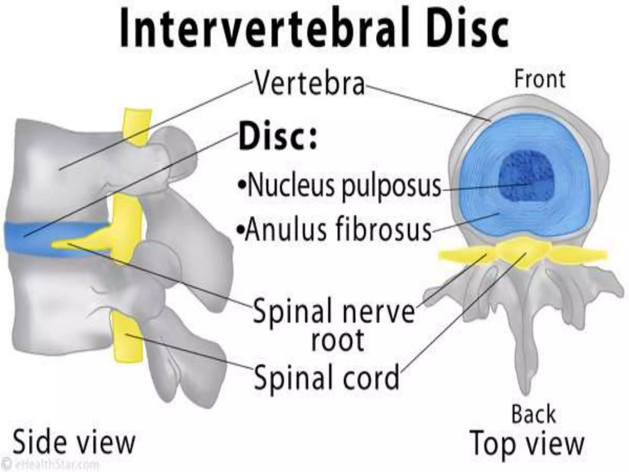 Lumbar spinal stenosis, laminectomy, prolapsed intervertebral disc | PPTX