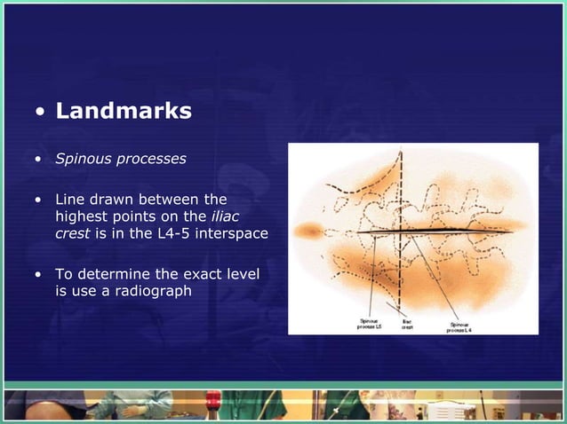 Lumbar spinal stenosis, laminectomy, prolapsed intervertebral disc | PPT