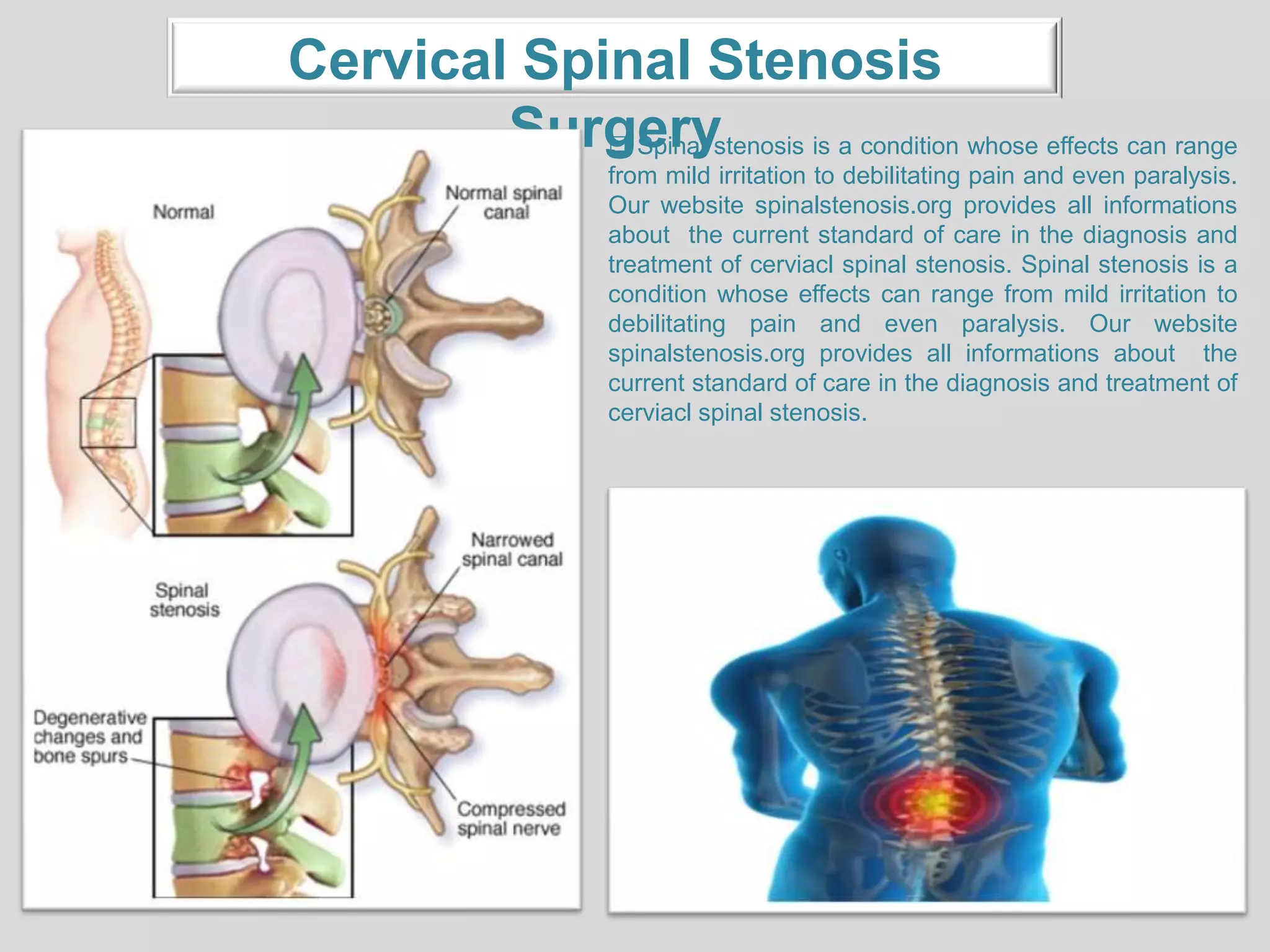 Lumbar spinal stenosis surgery | PPTX