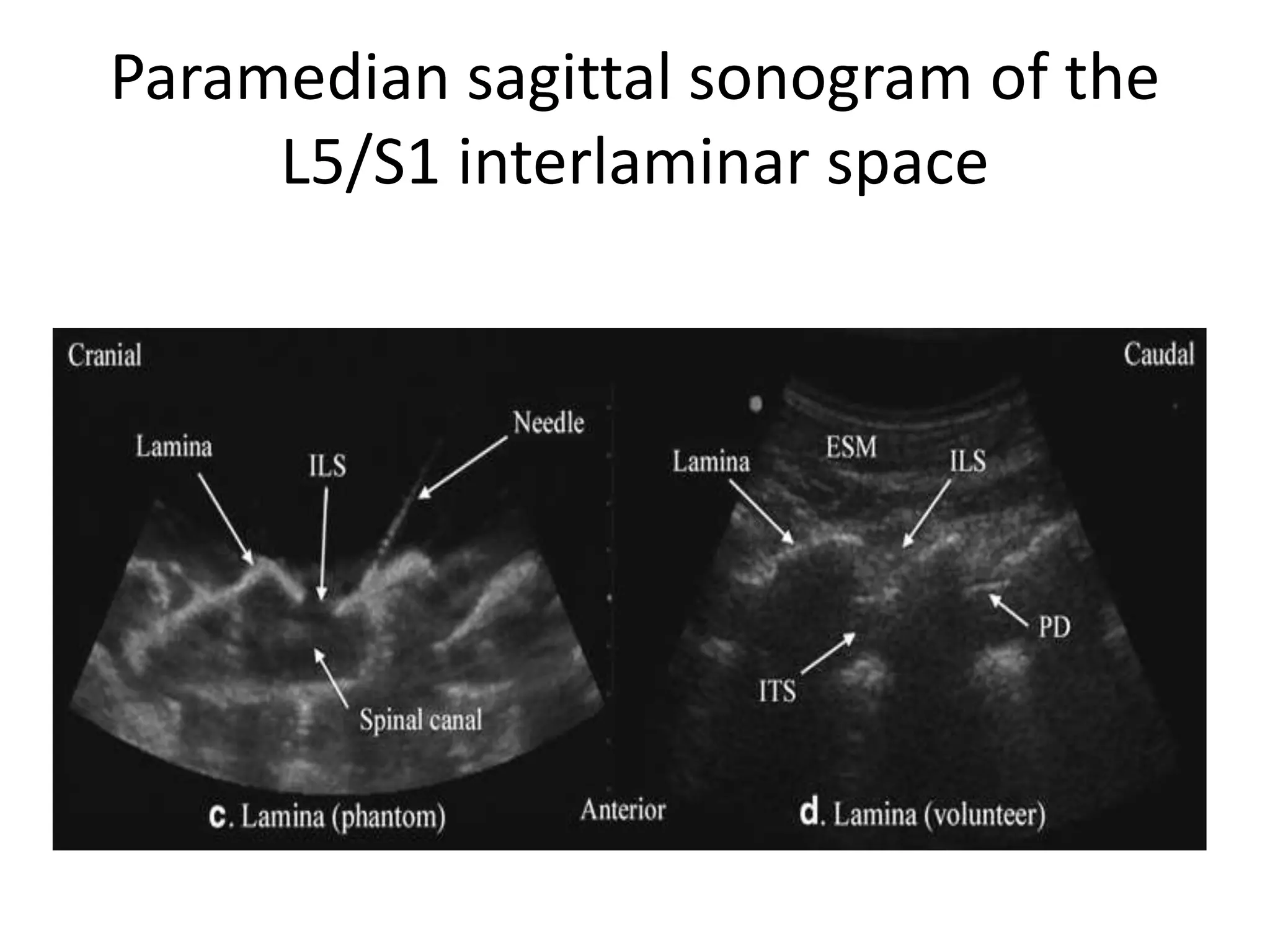 Lumbar spine sonoanatomy | PPTX