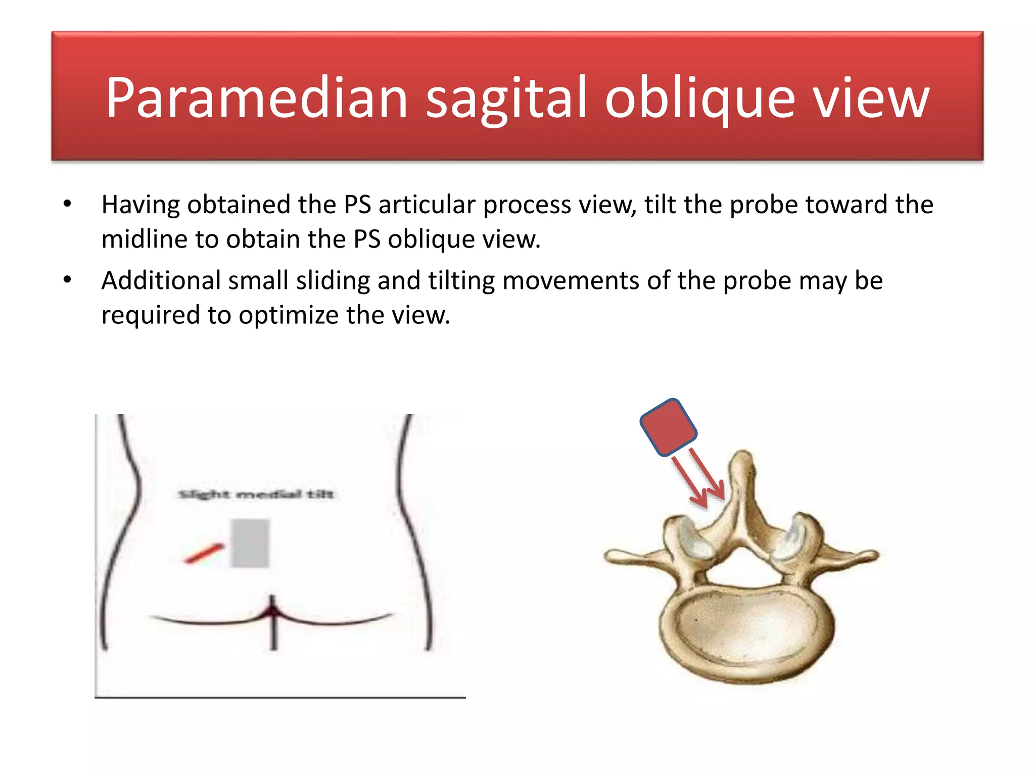Lumbar spine sonoanatomy | PPTX