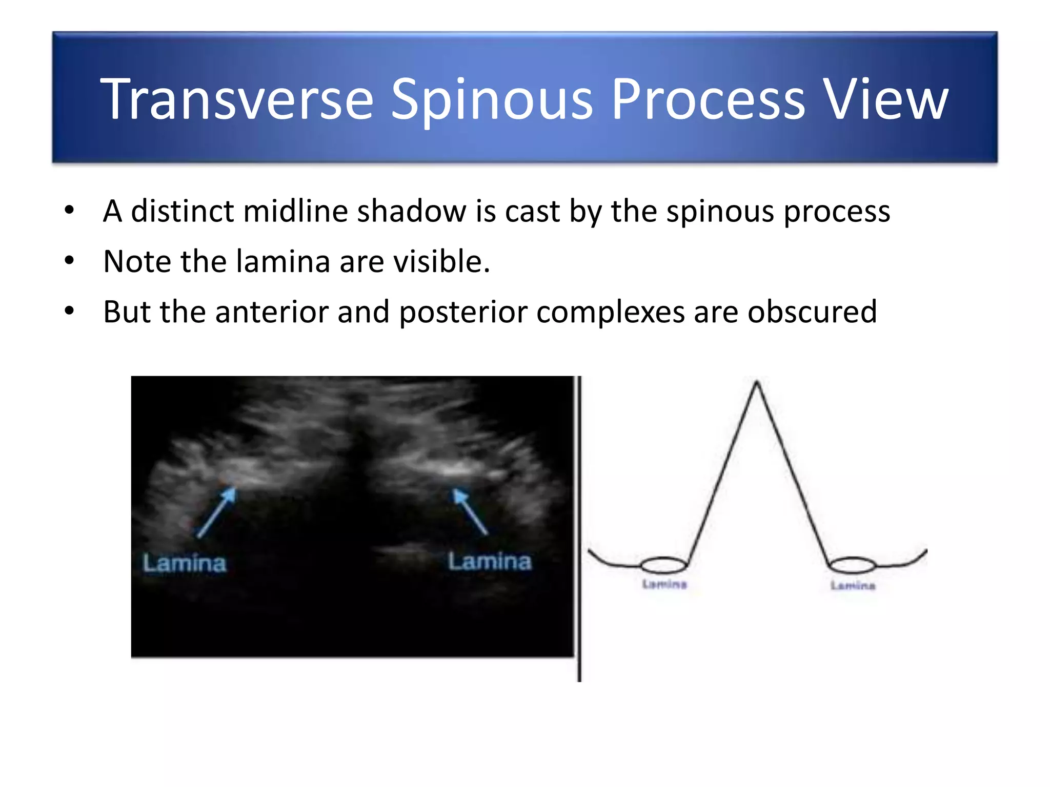 Lumbar spine sonoanatomy | PPTX