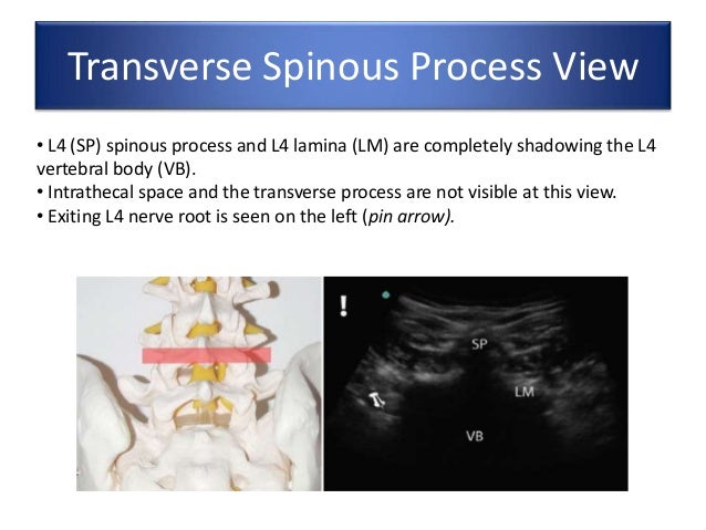 Lumbar spine sonoanatomy