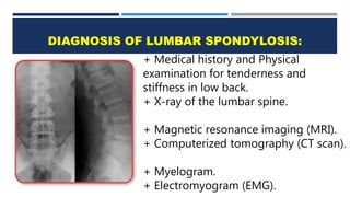 Lumbar spondylosis- Diagnosis | management | a brief medical study | PPTX