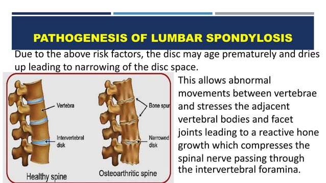 Lumbar spondylosis- Diagnosis | management | a brief medical study ...