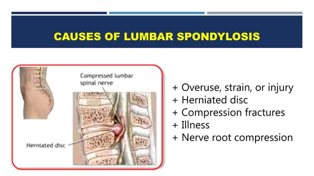Lumbar spondylosis- Diagnosis | management | a brief medical study ...