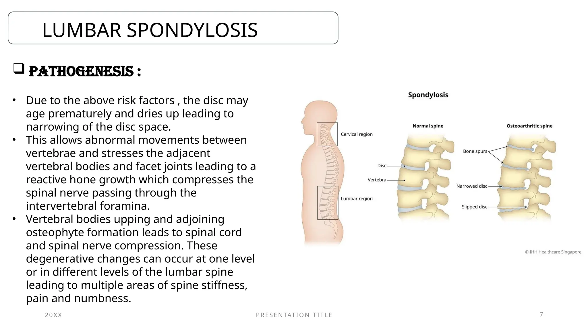 LUMBAR SPONDYLOSIS PARIMAL FINAL.pptx jsjshsh | PPTX | Death, Injury ...
