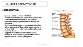 LUMBAR SPONDYLOSIS PARIMAL FINAL.pptx jsjshsh | PPTX