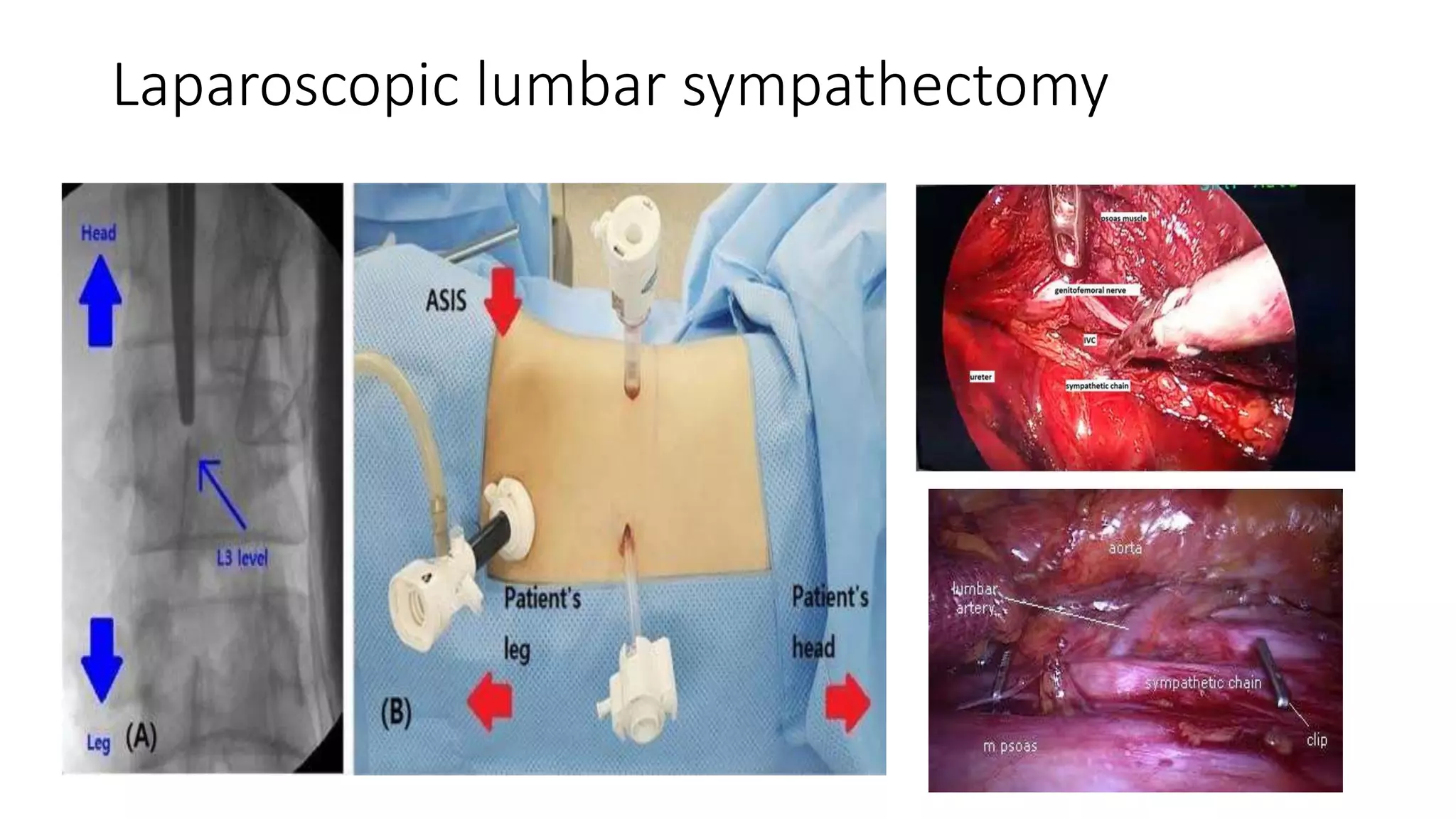 lumbar sympathectomy - Copy.pptx