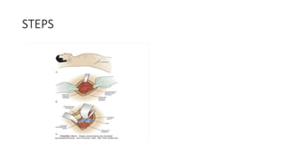 lumbar sympathectomy - Copy.pptx