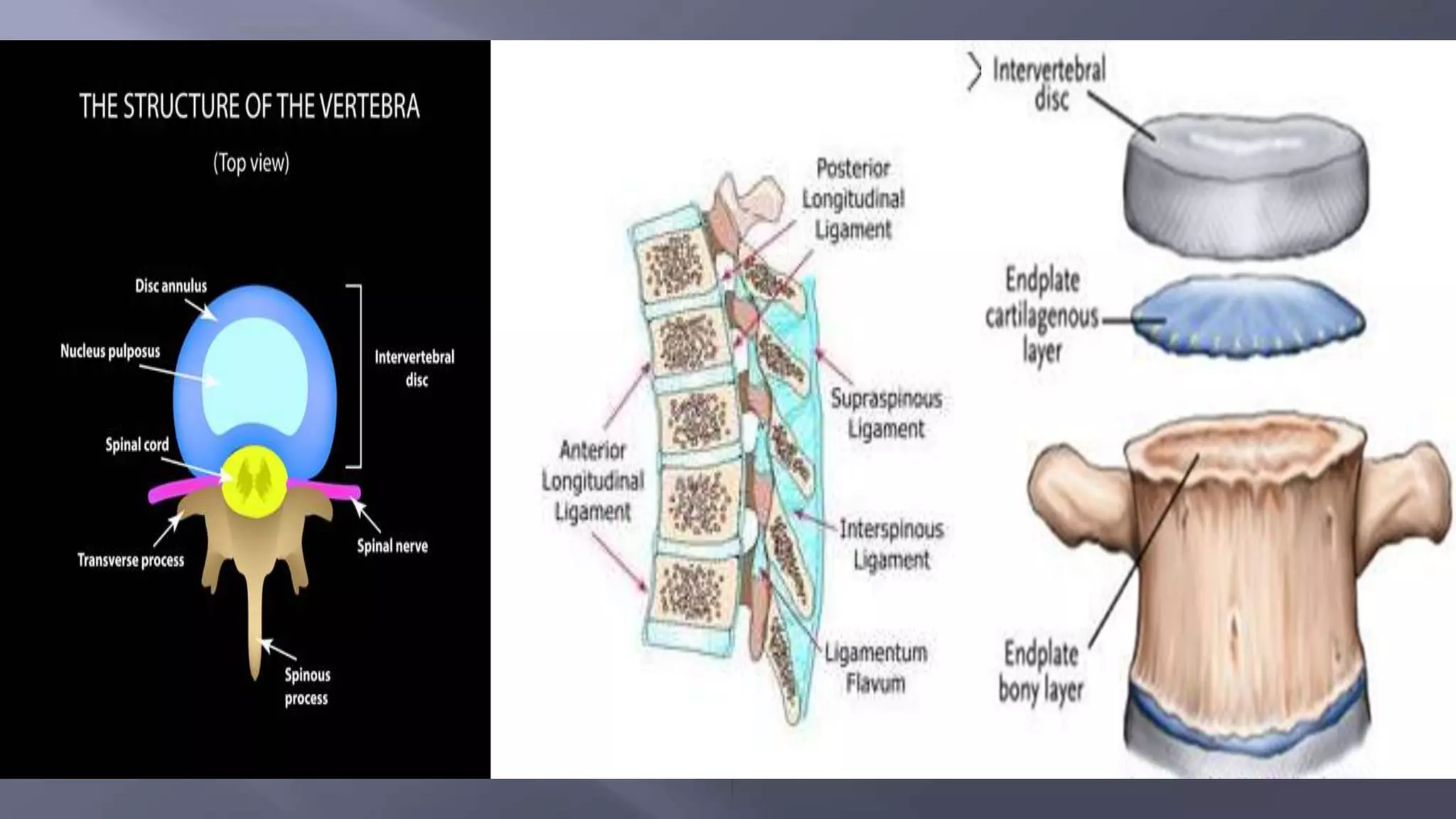 Lumber disc bulge/ Herniation/ Prolapse | PPTX