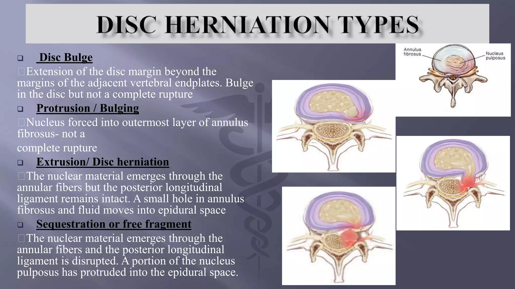 Lumber disc bulge/ Herniation/ Prolapse | PPTX
