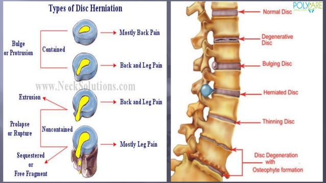 Lumber disc bulge/ Herniation/ Prolapse | PPTX