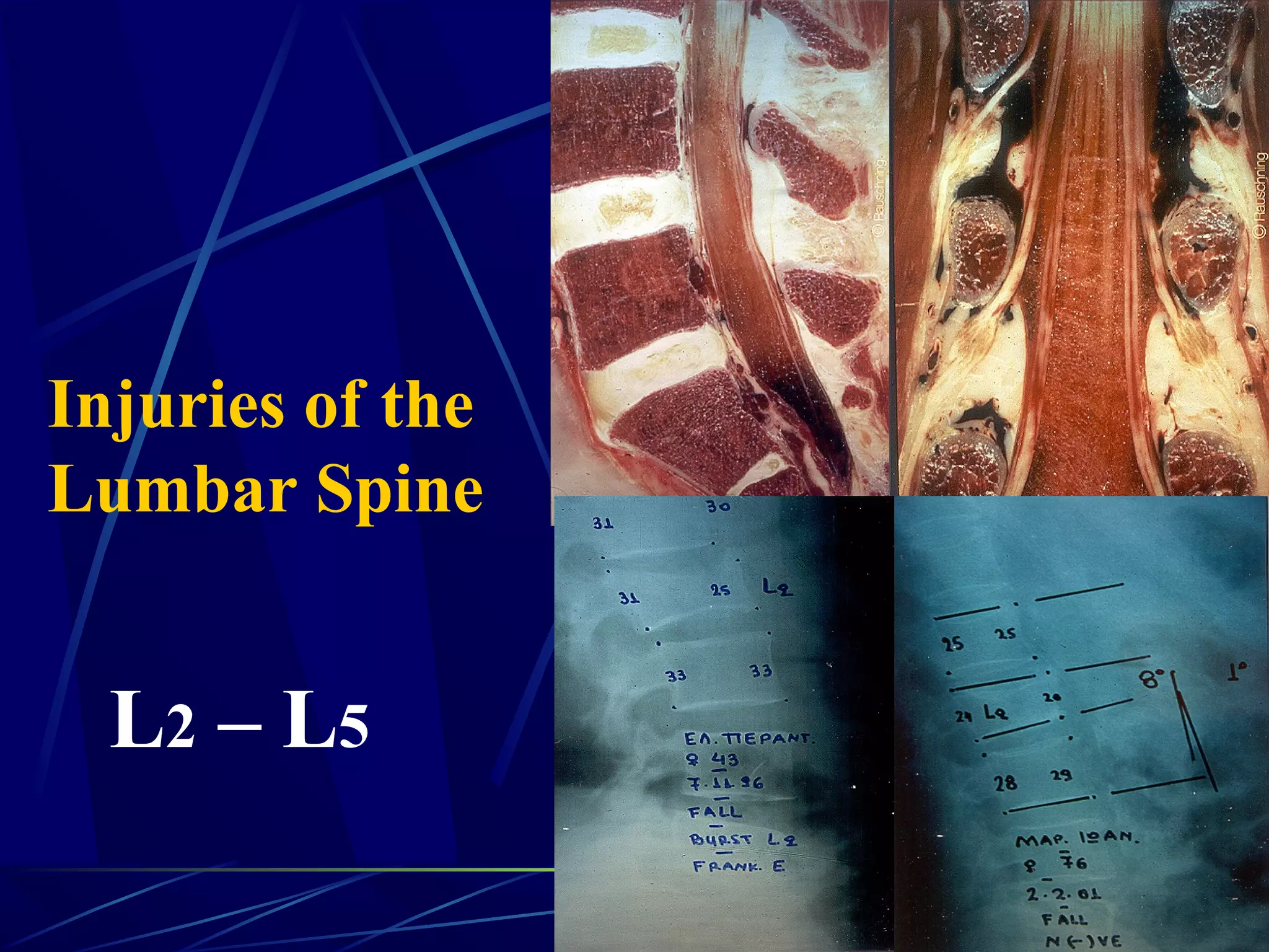 Lumbar Injuries | PPT