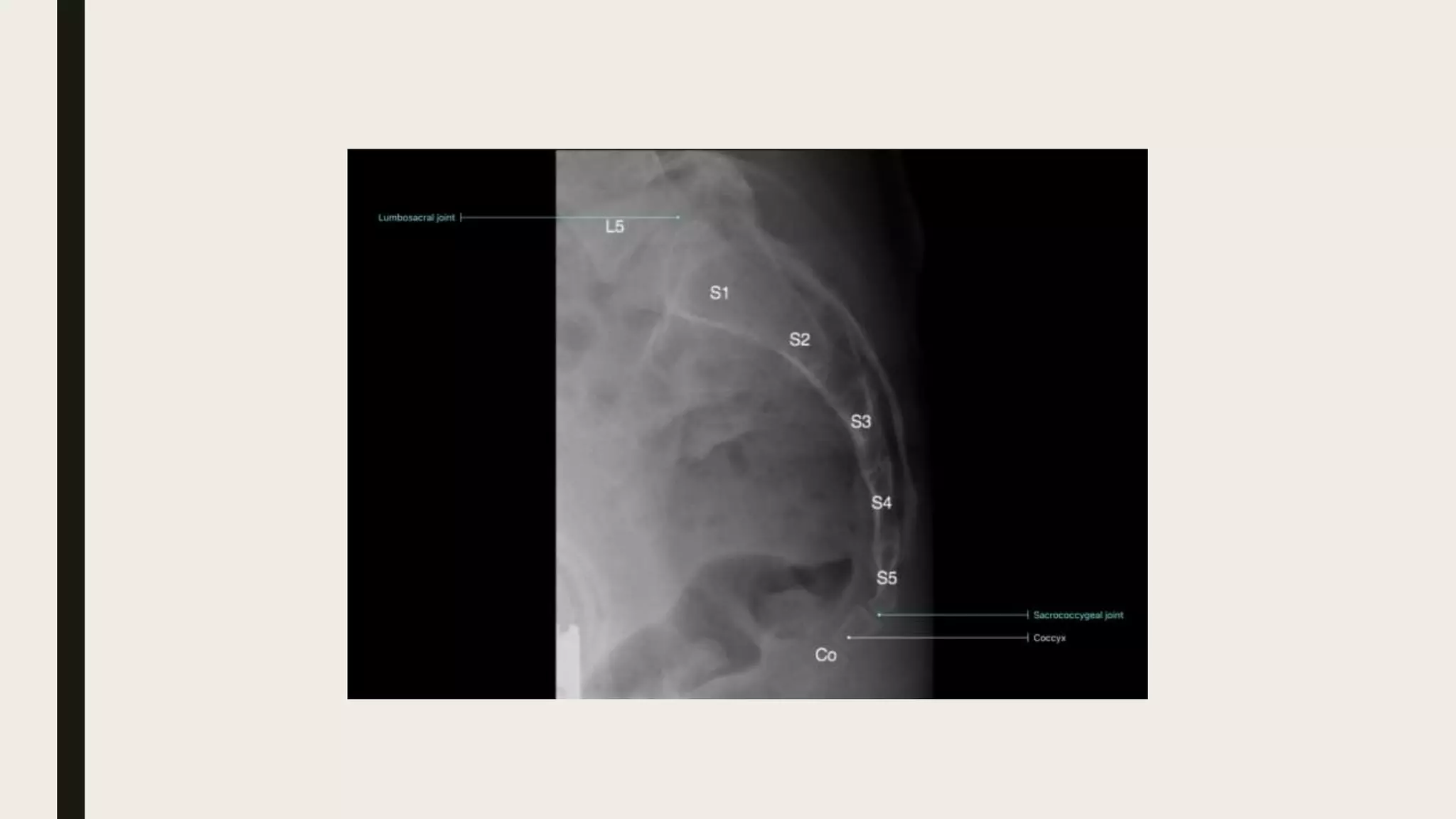 Lumbo sacral,coccyx sacrum anatomy and positioning | PPTX
