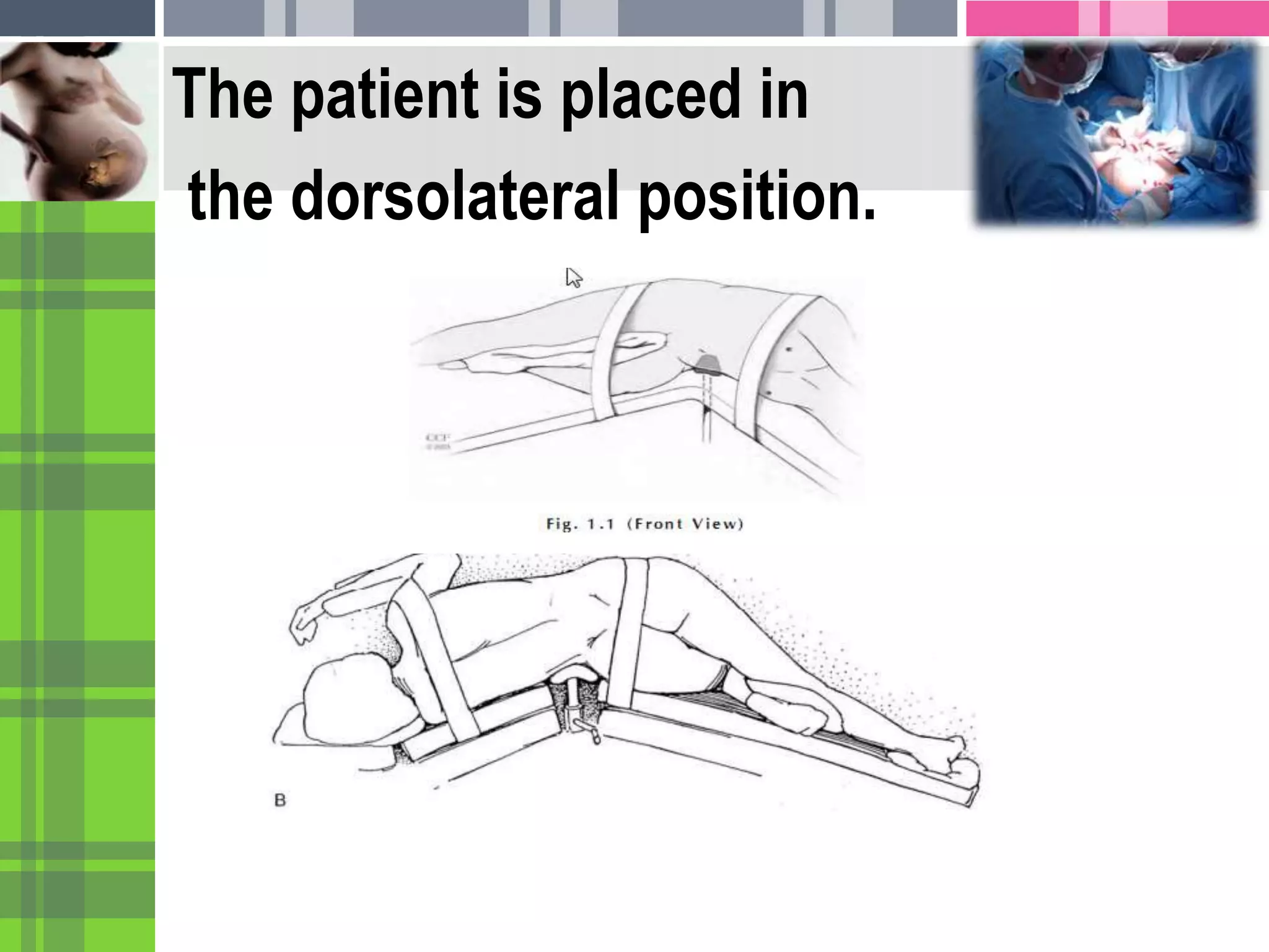 OPTEK Lumbotomy proximal ureterolithotomy | PPTX