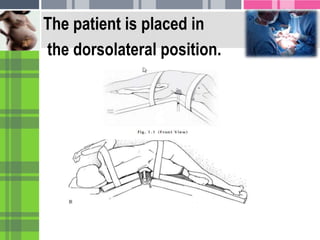 OPTEK Lumbotomy proximal ureterolithotomy | PPTX | Death, Injury, or ...