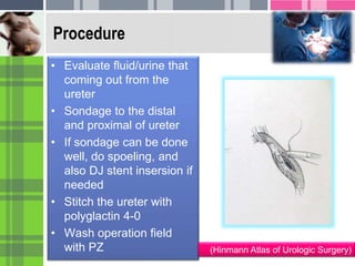 OPTEK Lumbotomy proximal ureterolithotomy | PPTX | Death, Injury, or ...